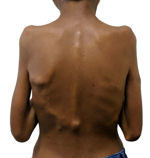 Patient Information - Understanding FOP – ABOUT FLARE-UPS