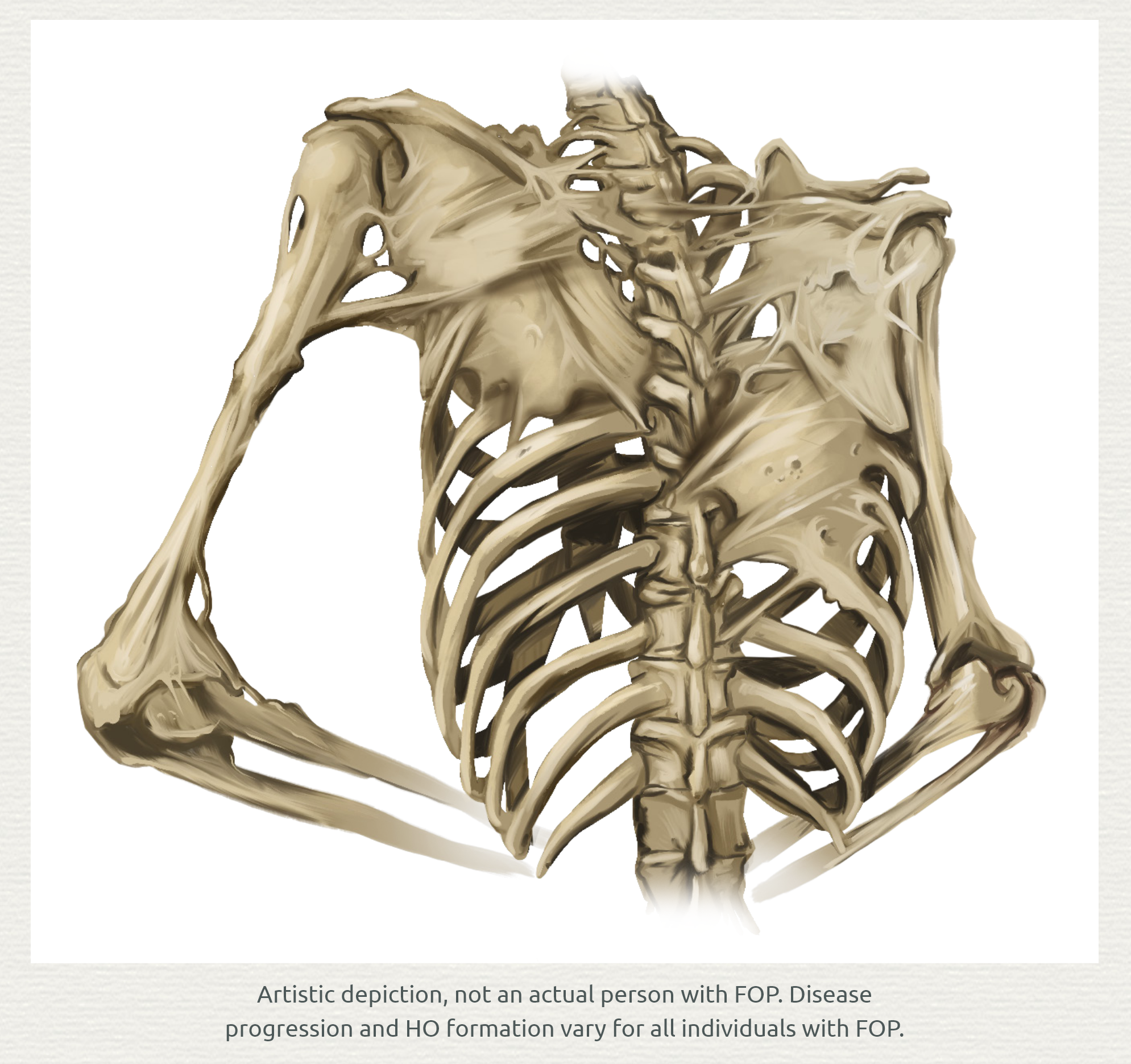 Patient Information - Understanding FOP – WHAT IS HO?
